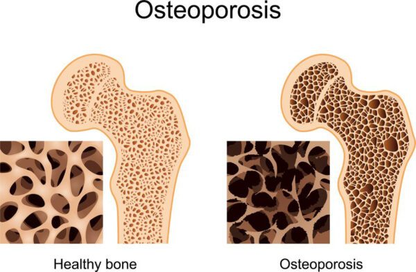 Understanding Osteoporosis Symptoms Causes And Treatment Sattvik